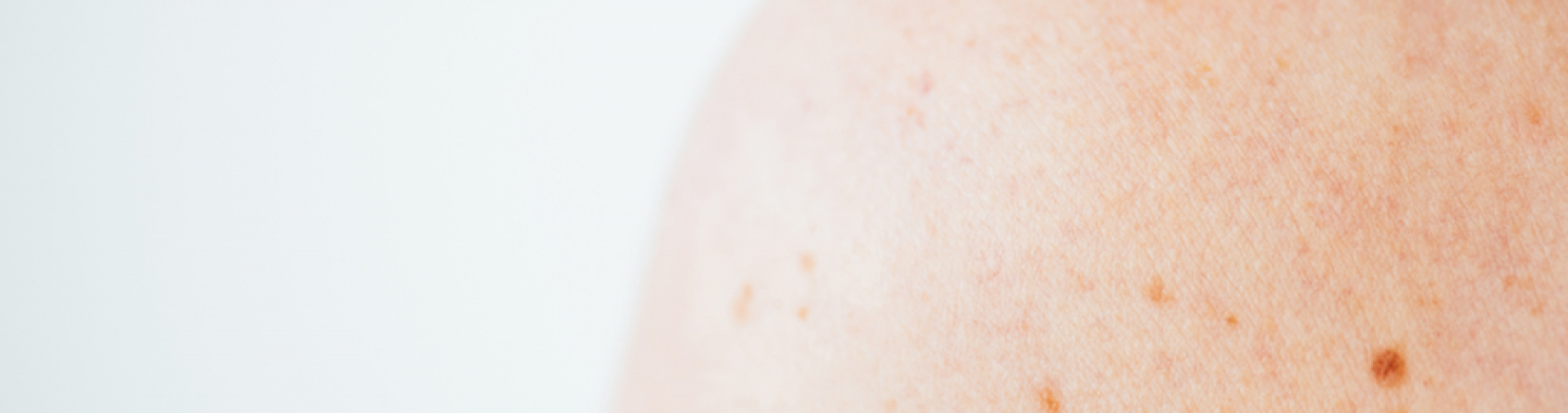 Cancers cutanés - Intervention chirurgicale - Dermatologue Kuenzli