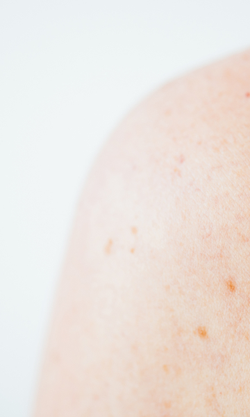 Cancers cutanés - Intervention chirurgicale - Dermatologue Kuenzli