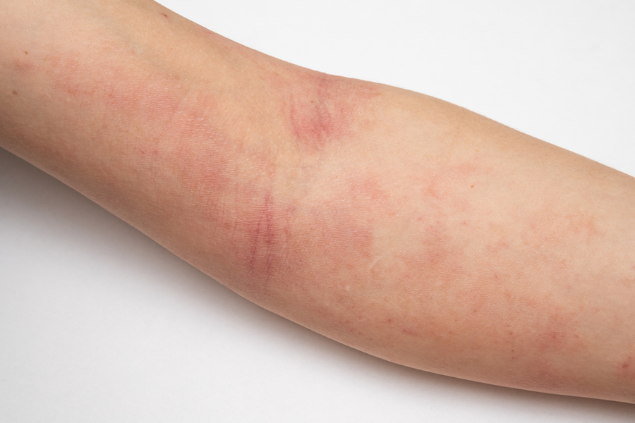 Maladies inflammatoires et dysimmunitaire - Cabinet Dermatologie
