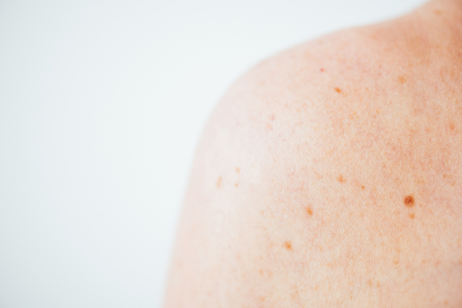 Mélanome Dépistez Vos Grains De Beauté Dermatologue Kuenzli